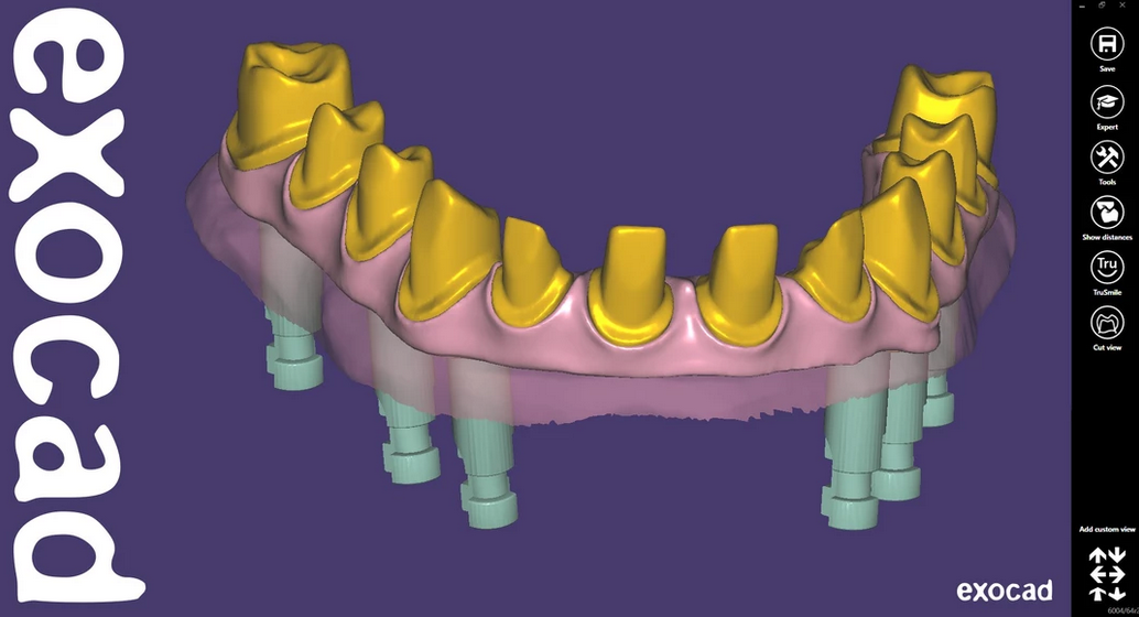 ExoCad Library available now – TOV Implant : blog officiel