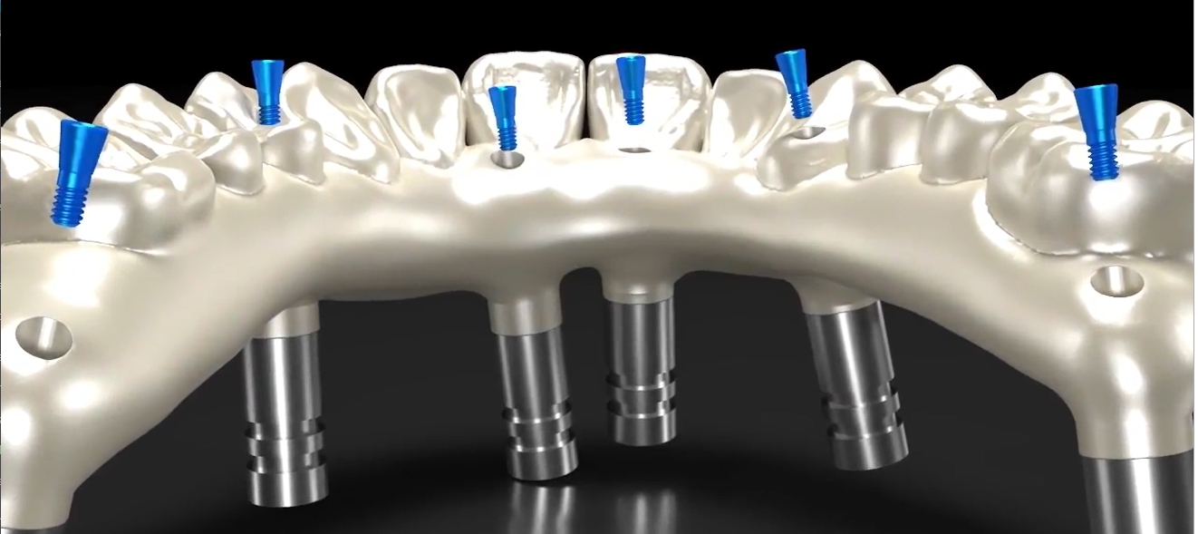 Rosen Screw – TOV Implant : blog officiel